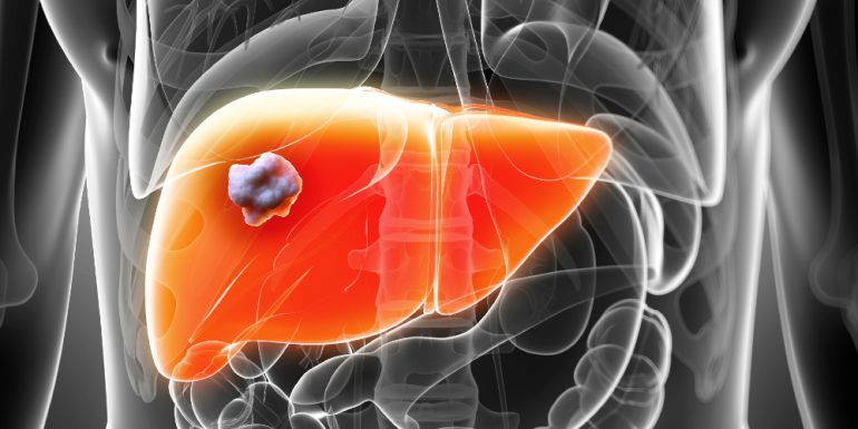 Una revolución en el tratamiento del cáncer de hígado | Ràdio Barcelona ...
