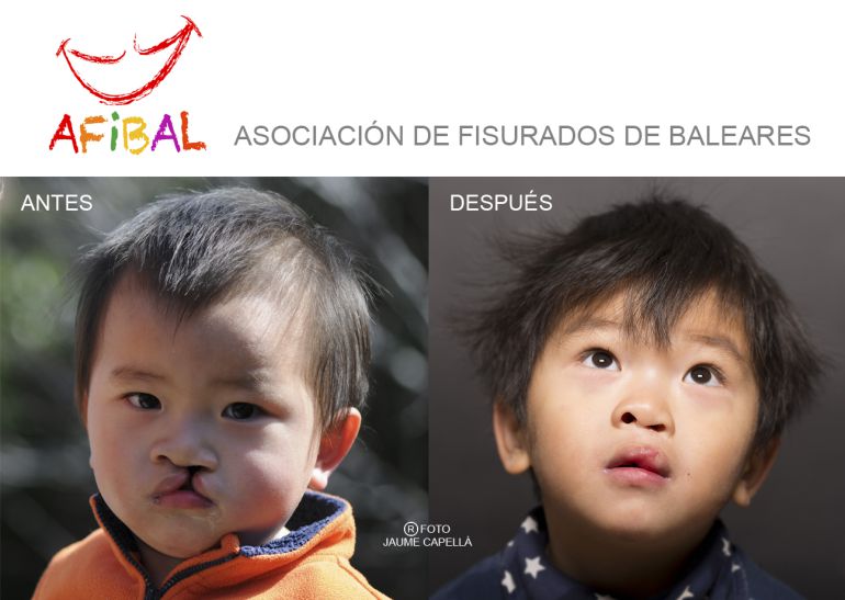 En Baleares hay unos 450 niños fisurados | radio_mallorca | Actualidad ...