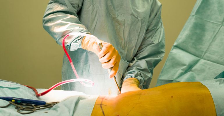 Investigación células madre: Cuando la grasa de las liposucciones cura ...